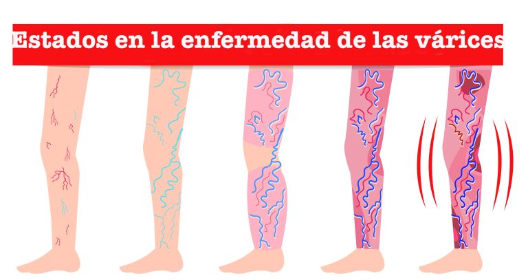 5 síntomas de que tus várices están siendo una amenaza para tu salud ...