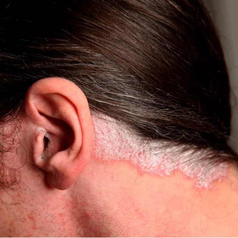 3 síntomas de que estás sufriendo de PSORIASIS y no te has dado cuenta ...