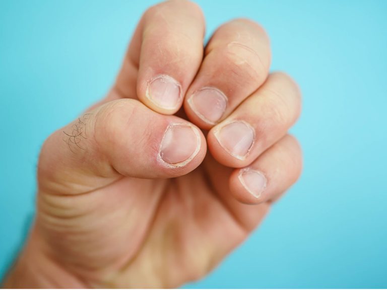 7 remedios al alcance de tu mano para acabar con los hongos de las uñas ...